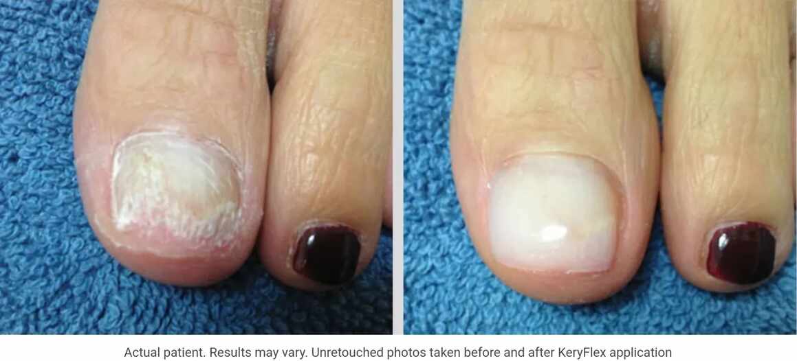 Toenail Restoration