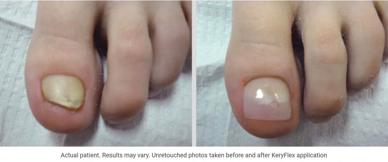 Toenail Restoration