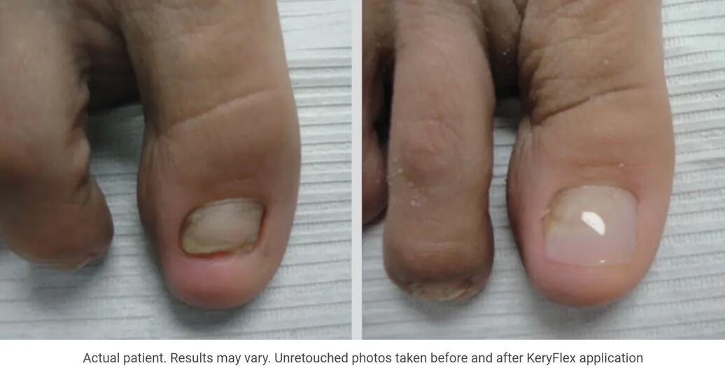 Toenail Restoration